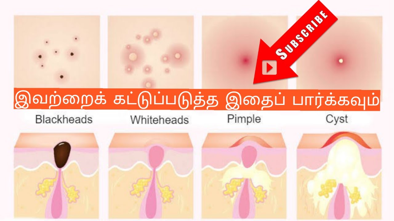 Get rid of pimples |Reduce Ance, Blackheads, whiteheads, pigmentation ...