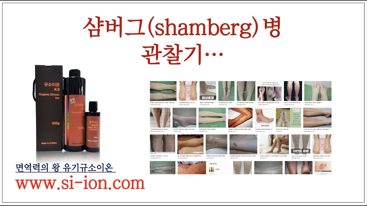 샴버그(shamberg)병에 대한 관찰기... - YouTube