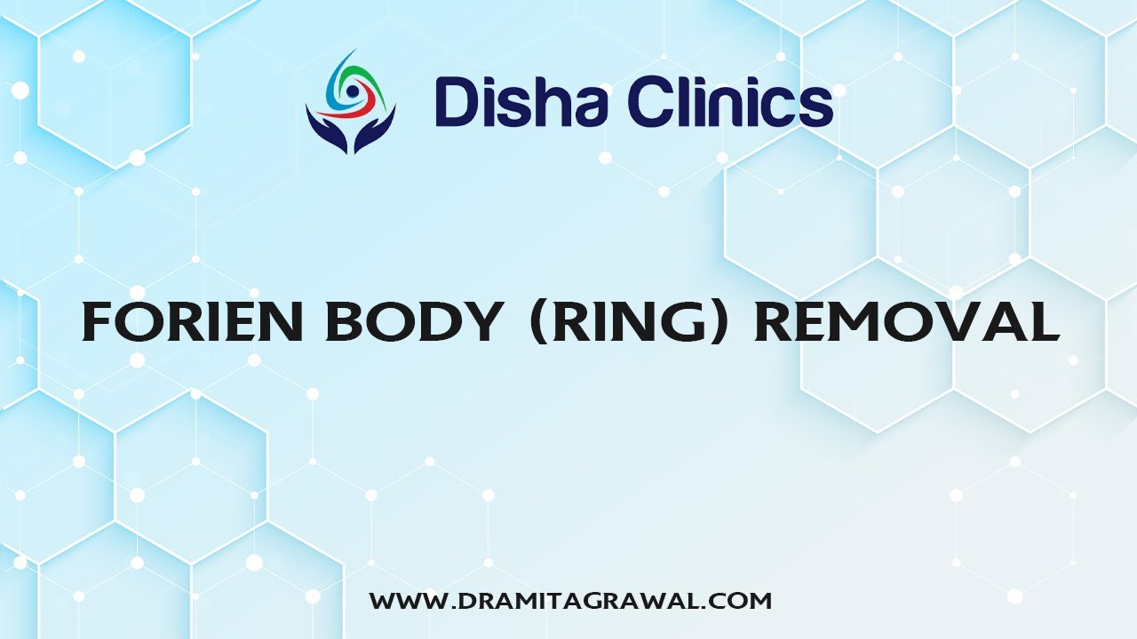 Forien body ring removal - YouTube