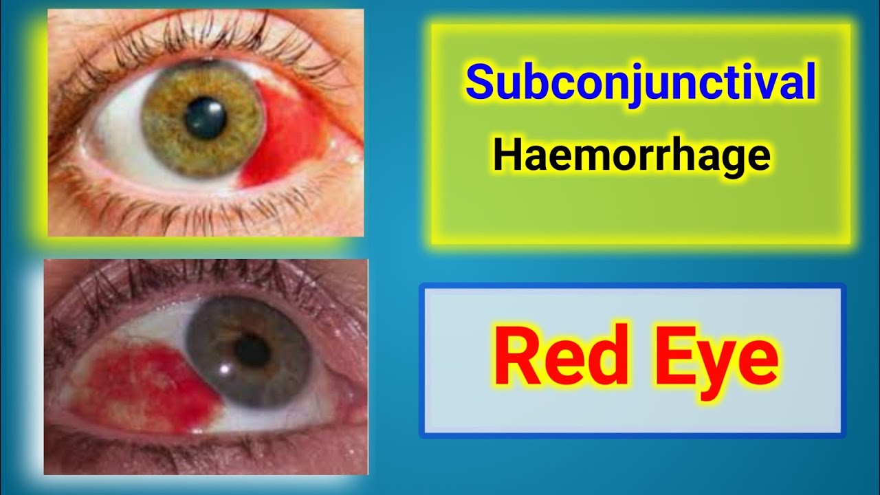 Subconjunctival Hemorrhage | आँख के सफेद हिस्से मे ब्लड जमना | Red spot ...