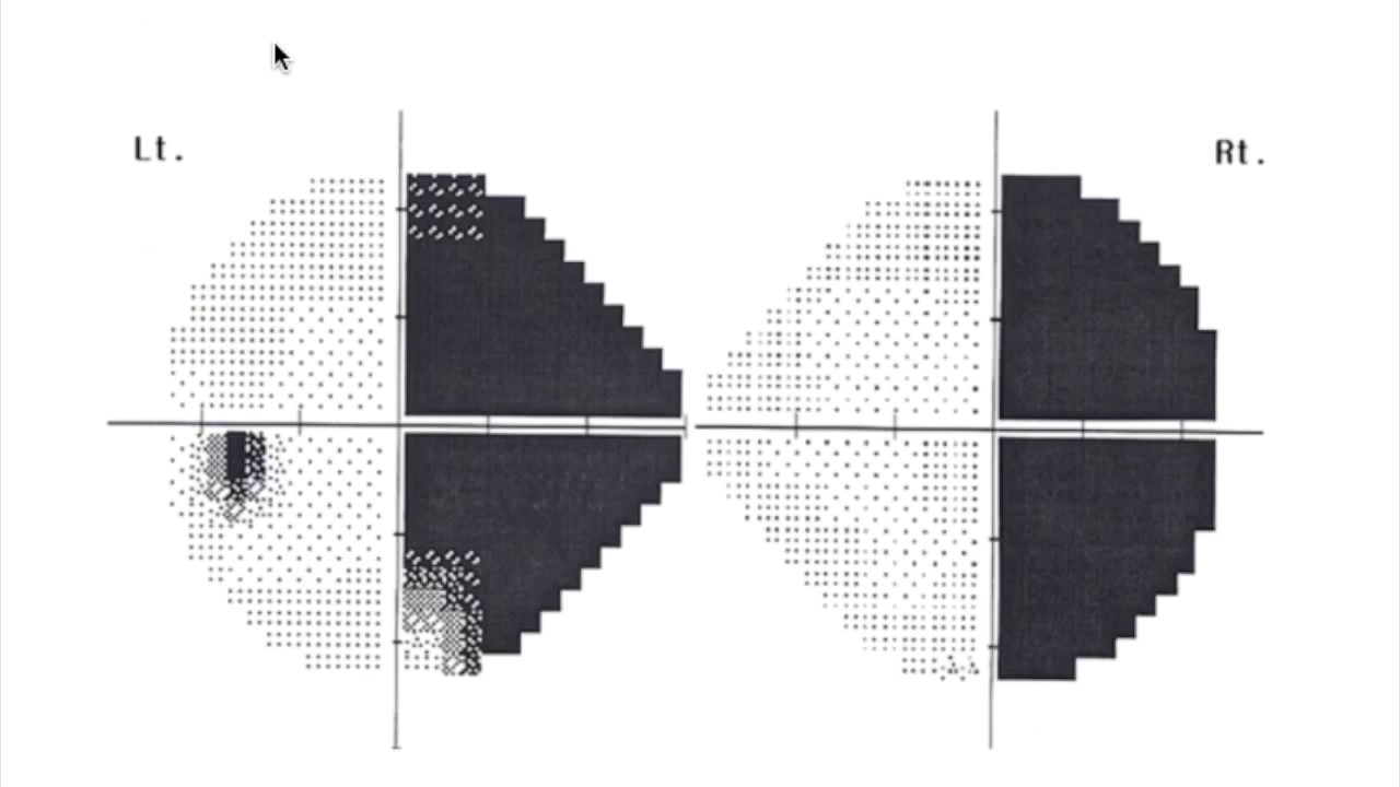 Scotoma Visual - YouTube