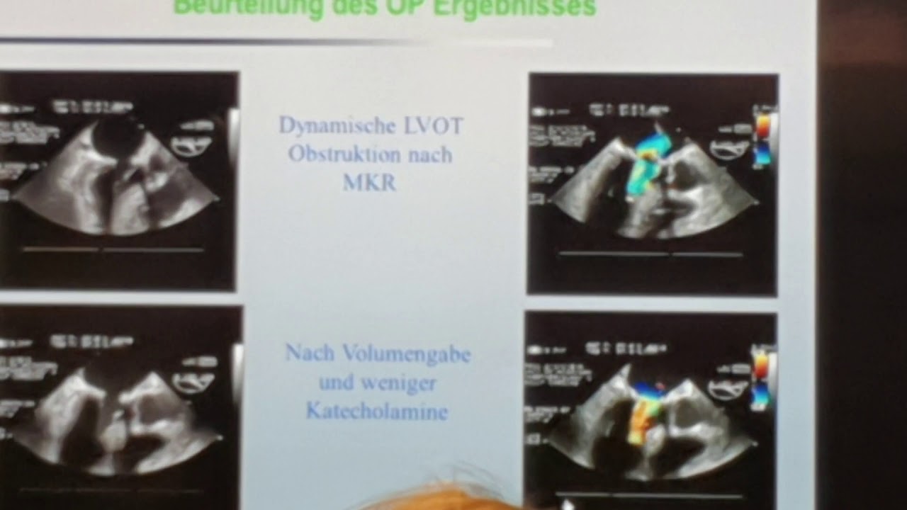 LVOT Obstruction after Mitral Valve surgery ttt give Fluid and not ...