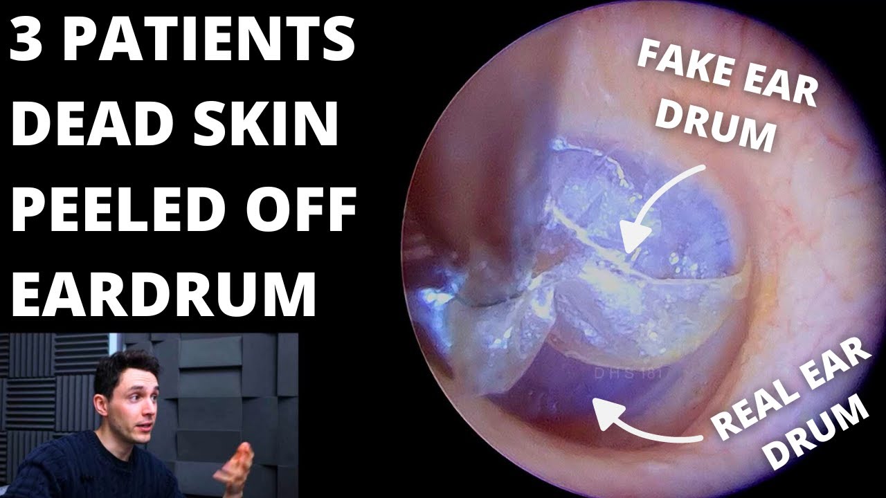 3 Patients With Dead Skin Trapping Eardrum (LIVE AUDIO LAST CASE) - YouTube