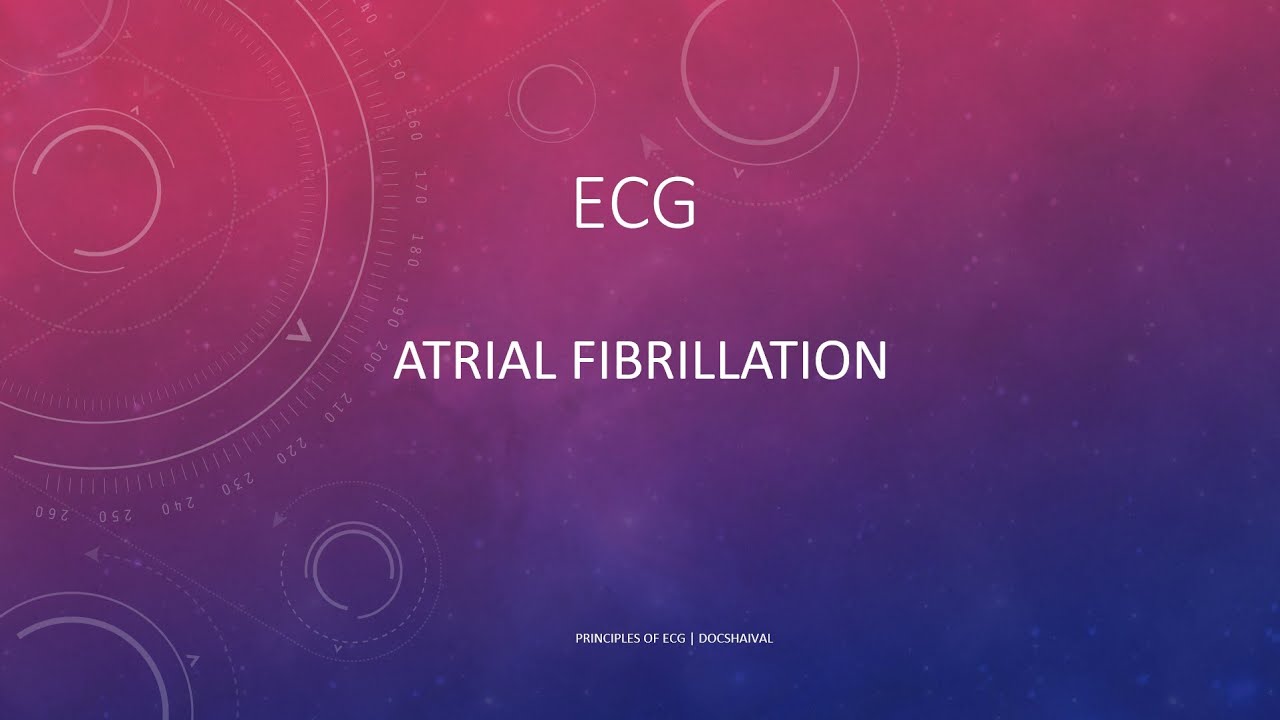 ECG: Atrial fibrillation (A-fib, AF) - causes, pathology, symptoms ...