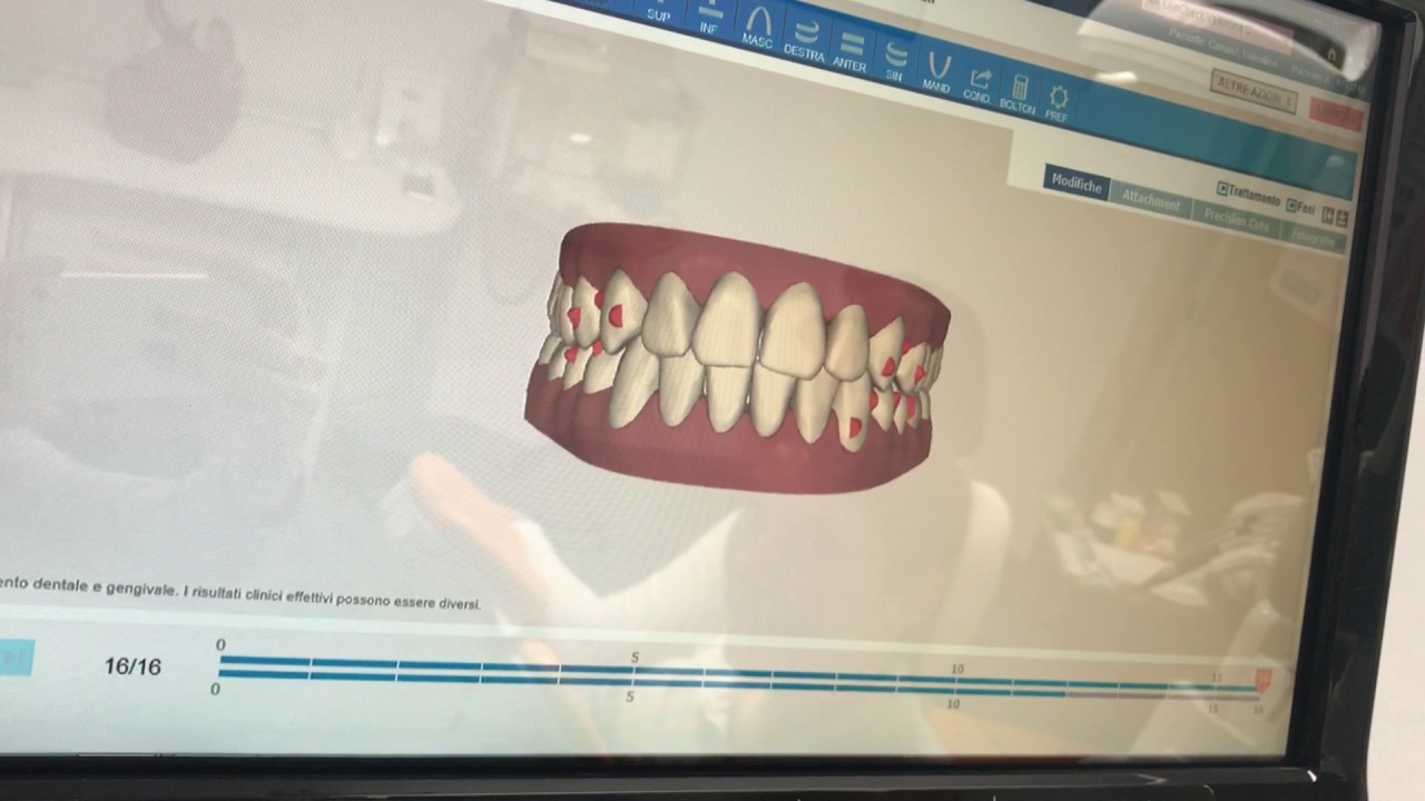 Video Invisalign ClinCheck - YouTube