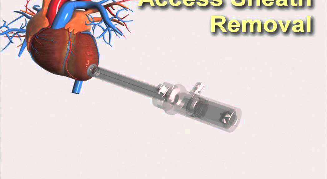 APICA Cardiovascular Ltd - YouTube