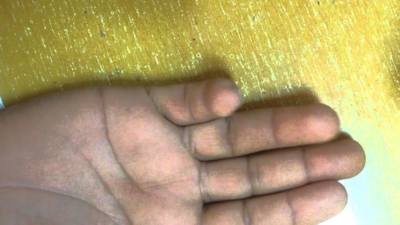 mobile flexion deformity of the little finger - YouTube