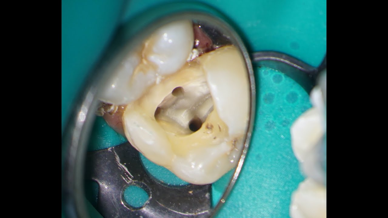 UL7 RCT stripped back to basics! - YouTube