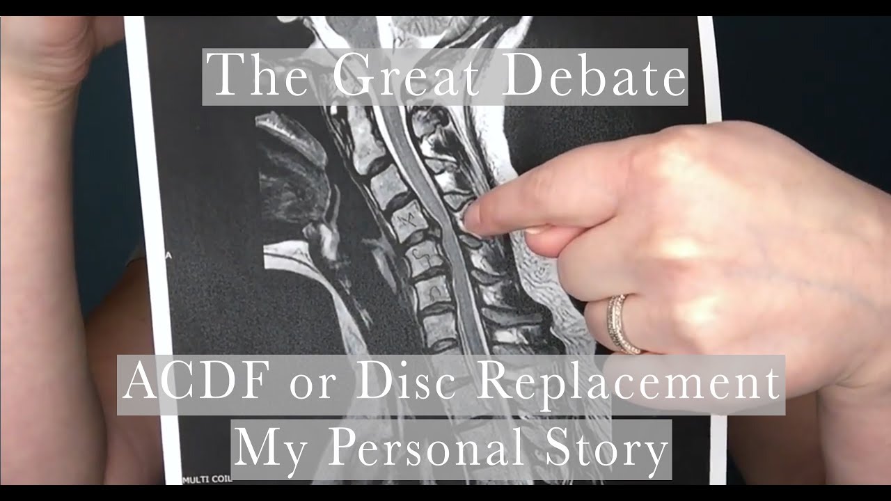 ACDF vs Disc Replacement / Cervical Fusion or Arthroplasty : My Pre ...