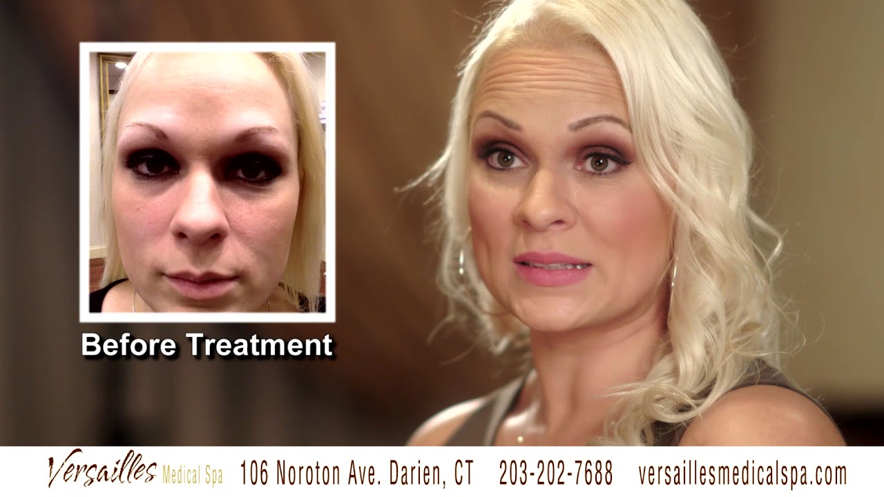 Versailles Medical Spa 2017 Commercials - YouTube