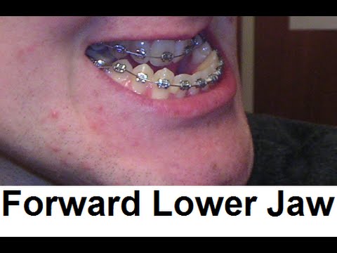 What Happens When Your Lower Jaw Grows Far Forward by Prof John Mew ...