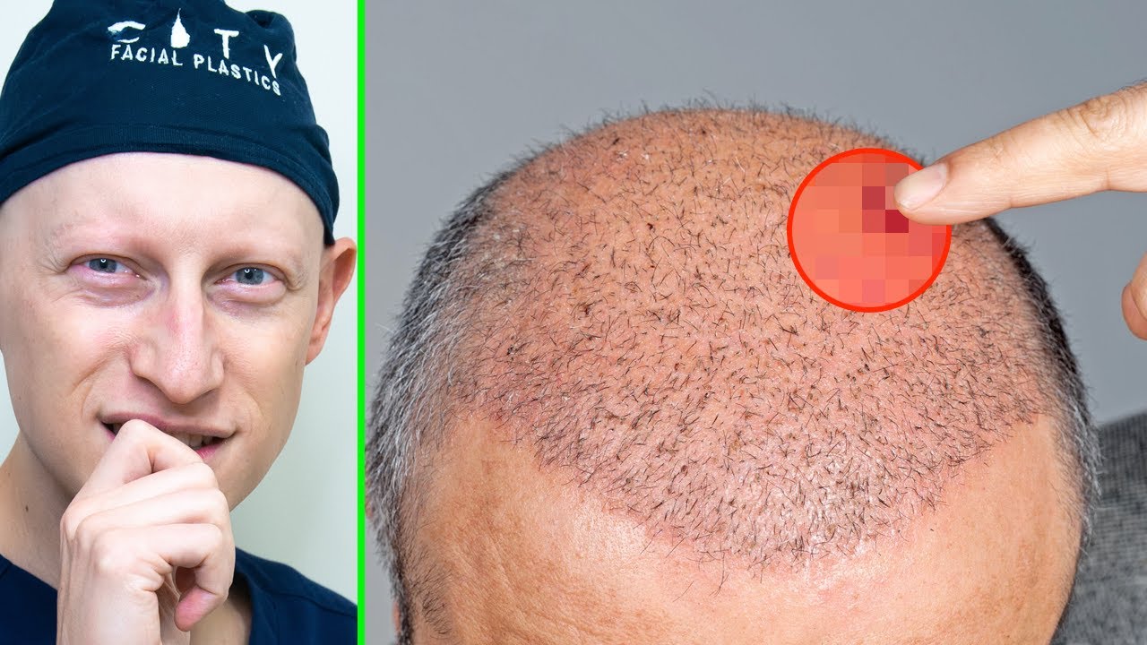 Undiscussed ISSUE after a Hair Transplant | Dr. Gary Linkov - YouTube