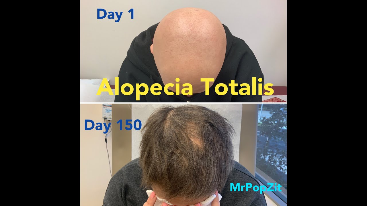 Alopecia Totalis