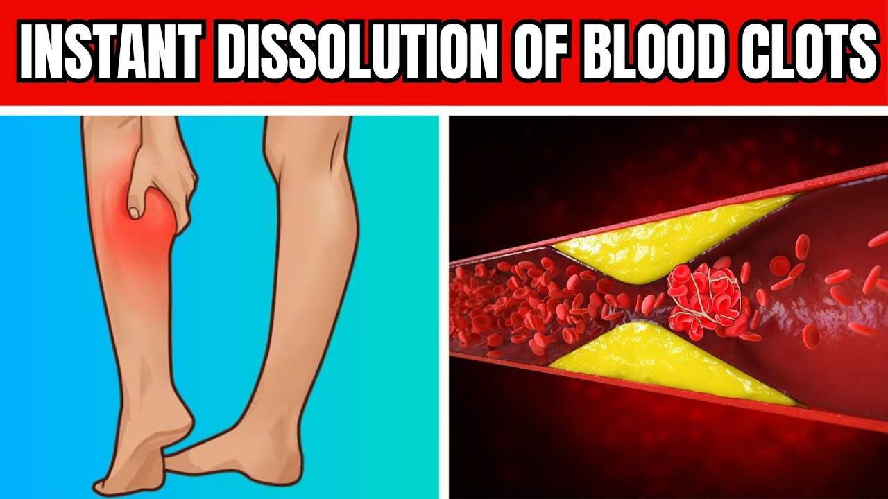 These 7 Foods Will Instantly Dissolve Blood Clots In The Vessels - YouTube