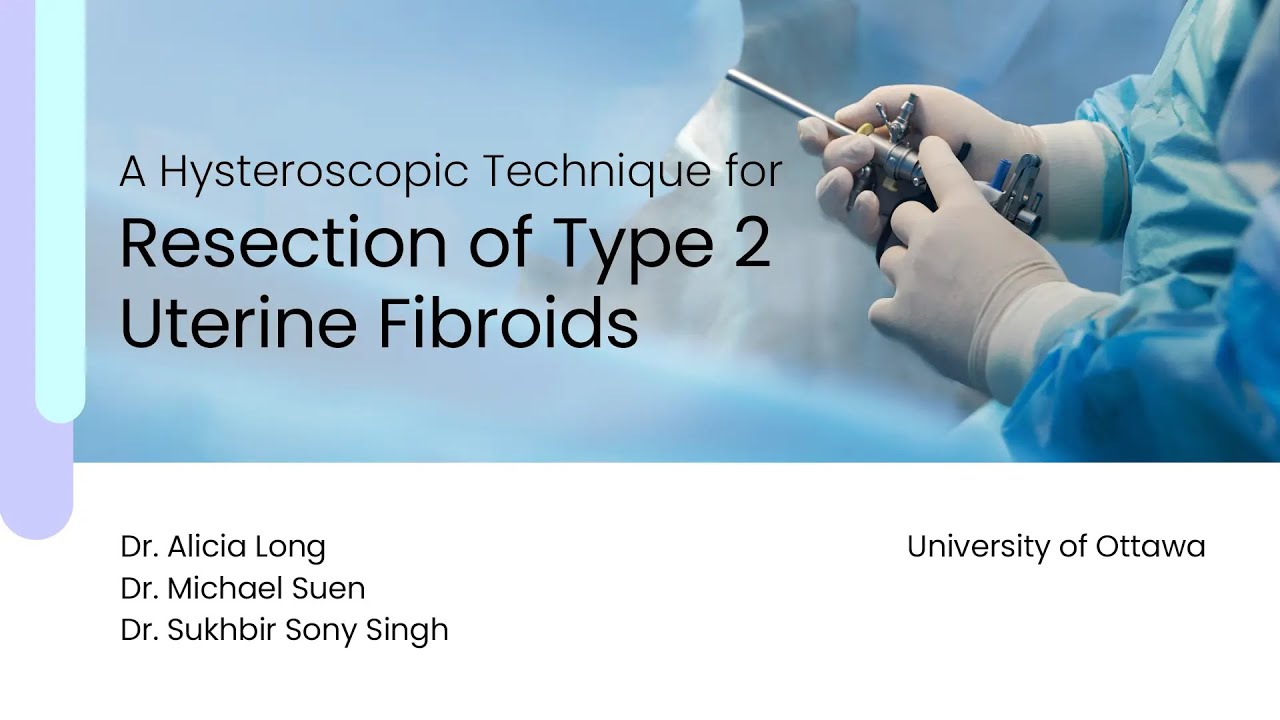 A Hysteroscopic Technique for Resection of Type 2 Uterine Fibroids ...