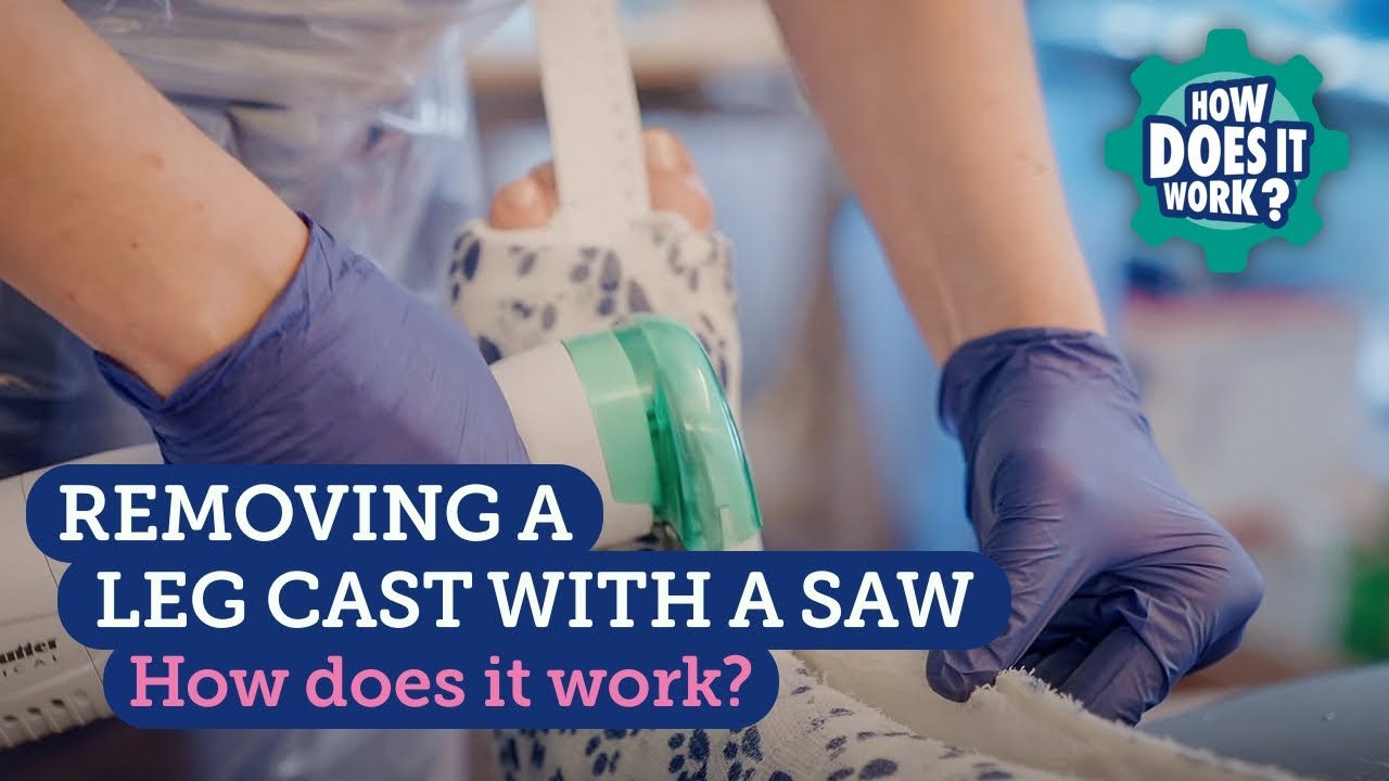 Removing a Leg Cast with a Saw (Teenagers) - YouTube