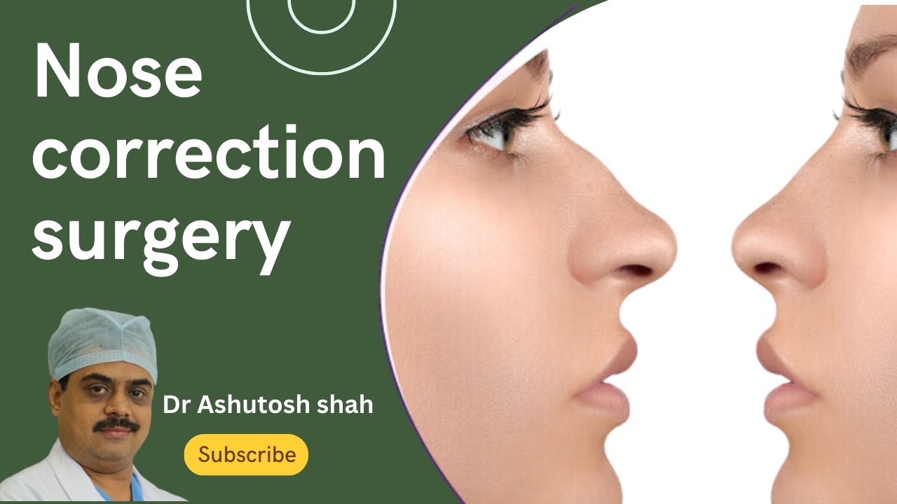 Patient Review Nose correction surgery, Rhinoplasty surgery, nose job ...