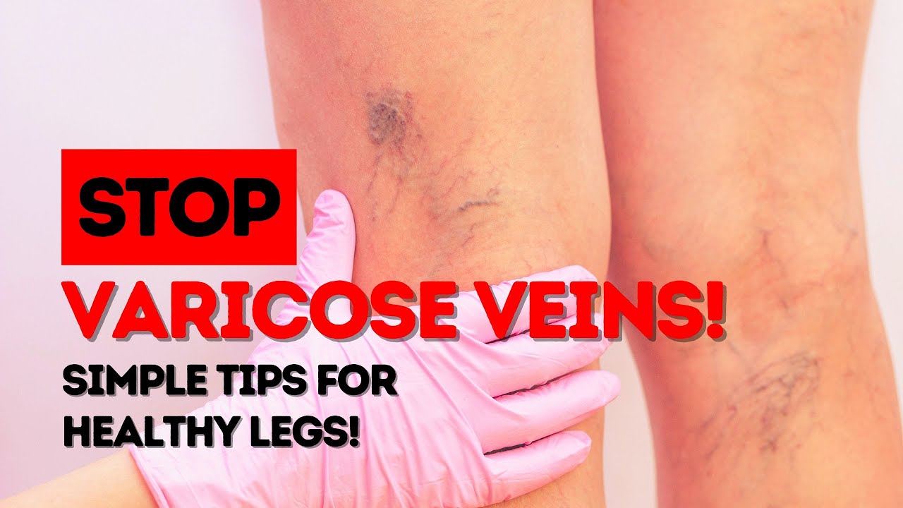 Stop Varicose Veins Before They Start: Essential Tips for Vibrant ...