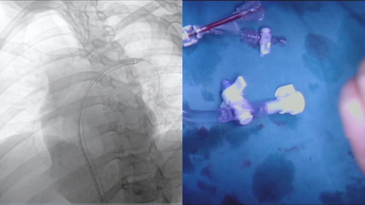 Pulmonary Artery Embolectomy using the INARI FlowTriever Maham Rahimi ...