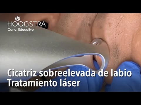 Cicatriz sobreelevada de labio - Tratamiento láser - 22142 - YouTube