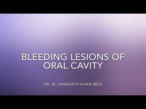 Bleeding lesions of oral cavity - YouTube