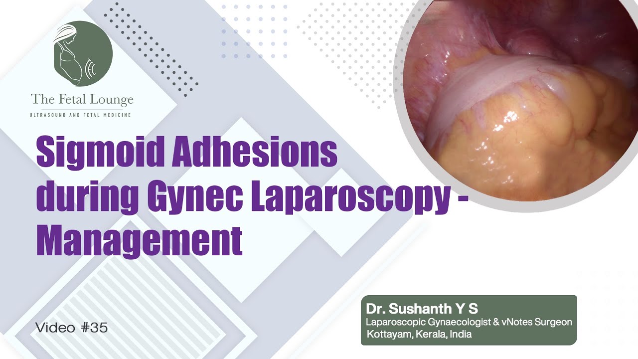 HOW TO TACKLE SIGMOID ADHESIONS IN GYNECOLOGICAL LAPAROSCOPY - YouTube