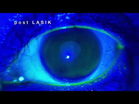 post LASIK eye - YouTube