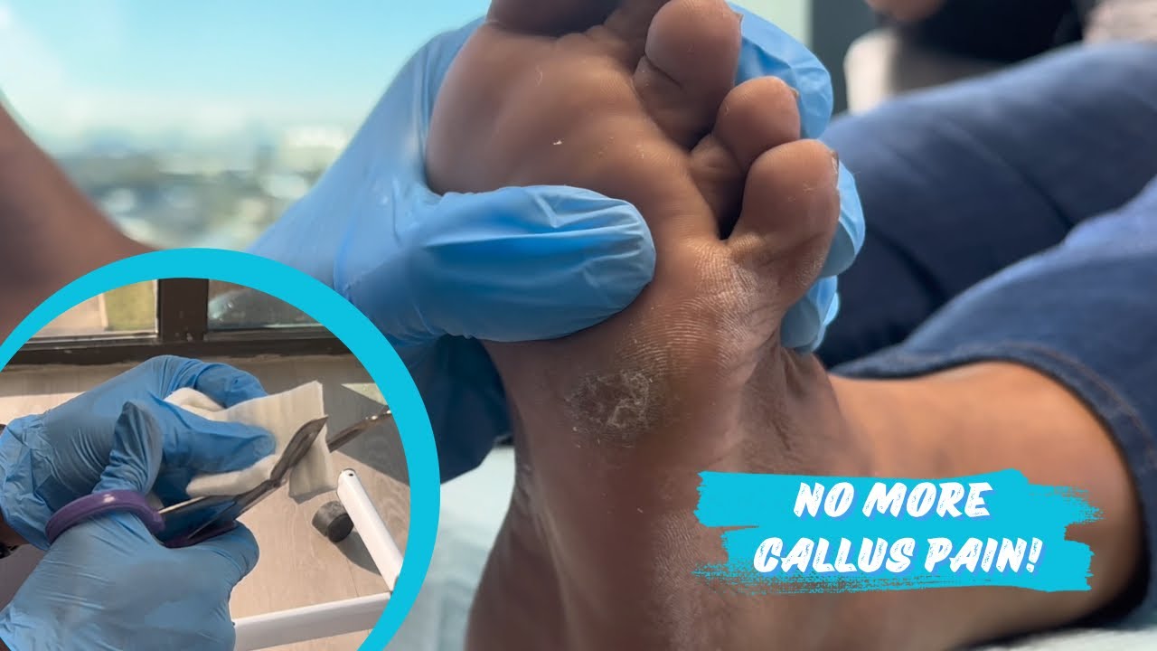 Callus Pain Relief: Proven Tips and Tricks | MediPedi Spa - YouTube