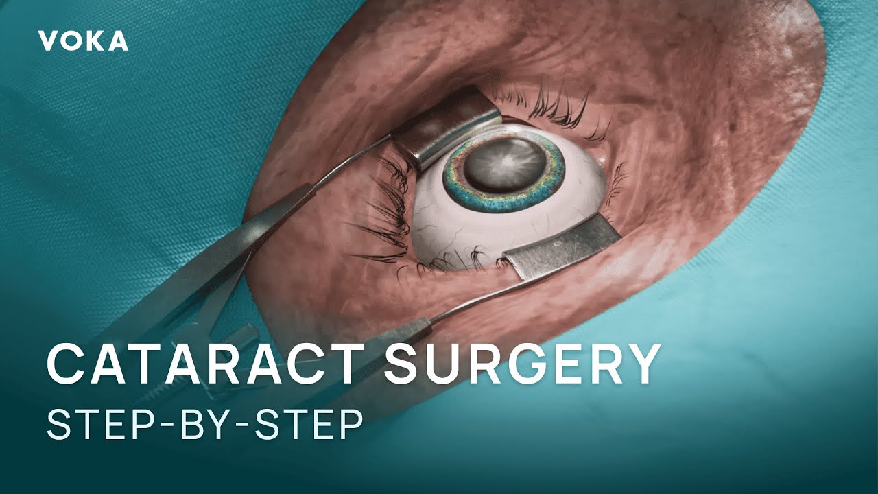 Cataract Surgery Explained in 3D: Phacoemulsification Step-by-Step ...