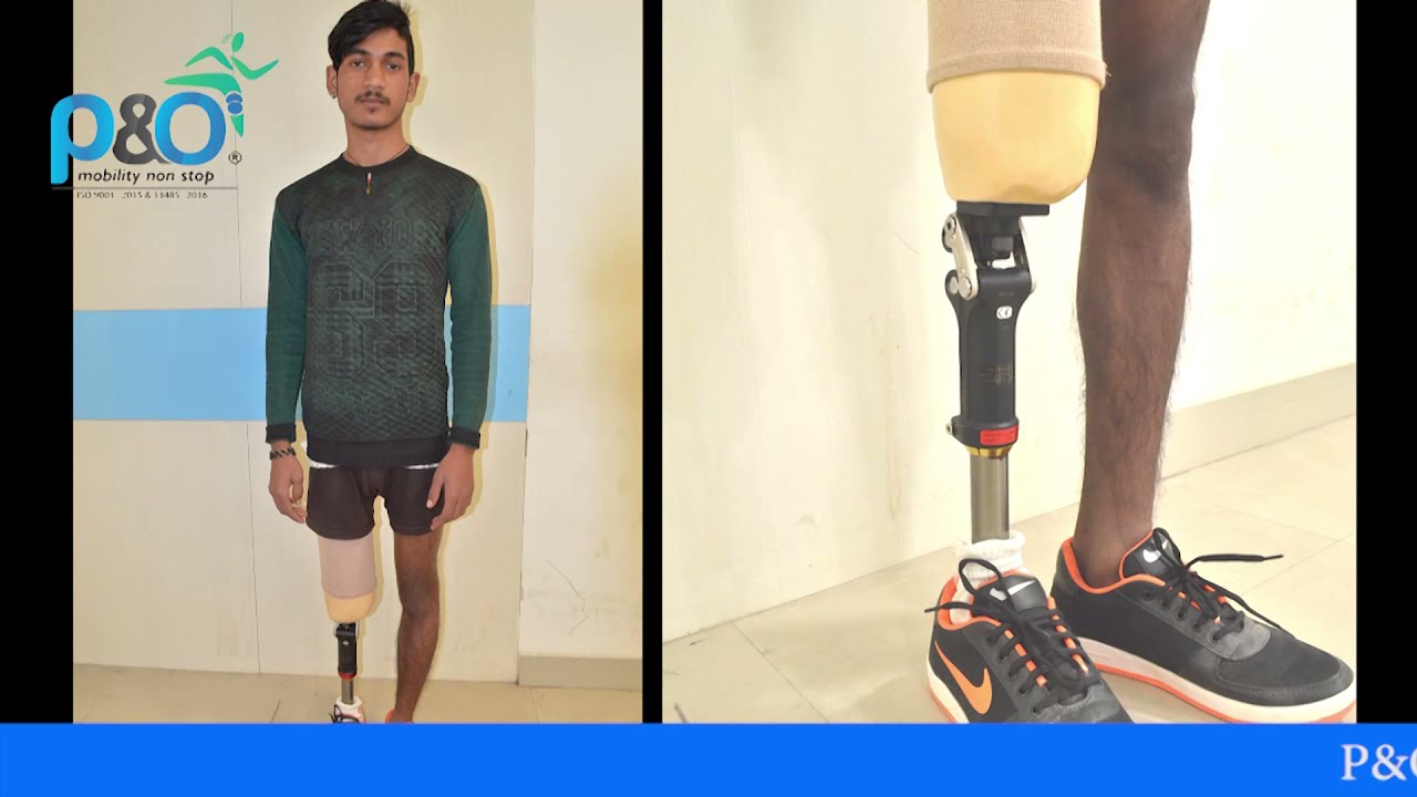 Knee Disarticulation Prosthesis