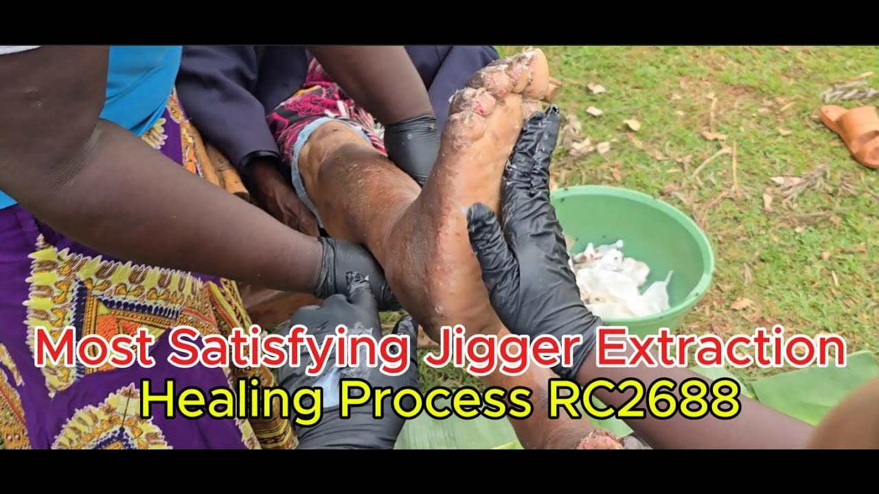 Most Satisfying Jigger Extraction: Deep Cleaning and Healing Process # ...