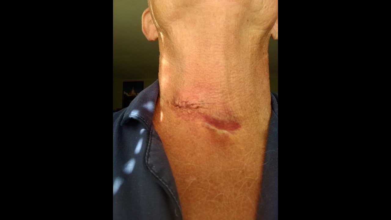 Recovery Period For Acdf Surgery at Ester Gordan blog