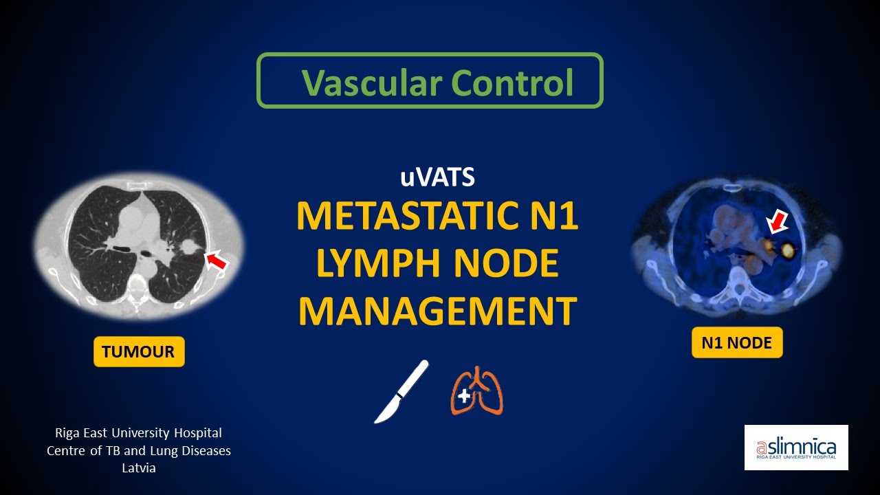 Management of Positive N1 Lymph Node in Fissureless Lobectomy - YouTube