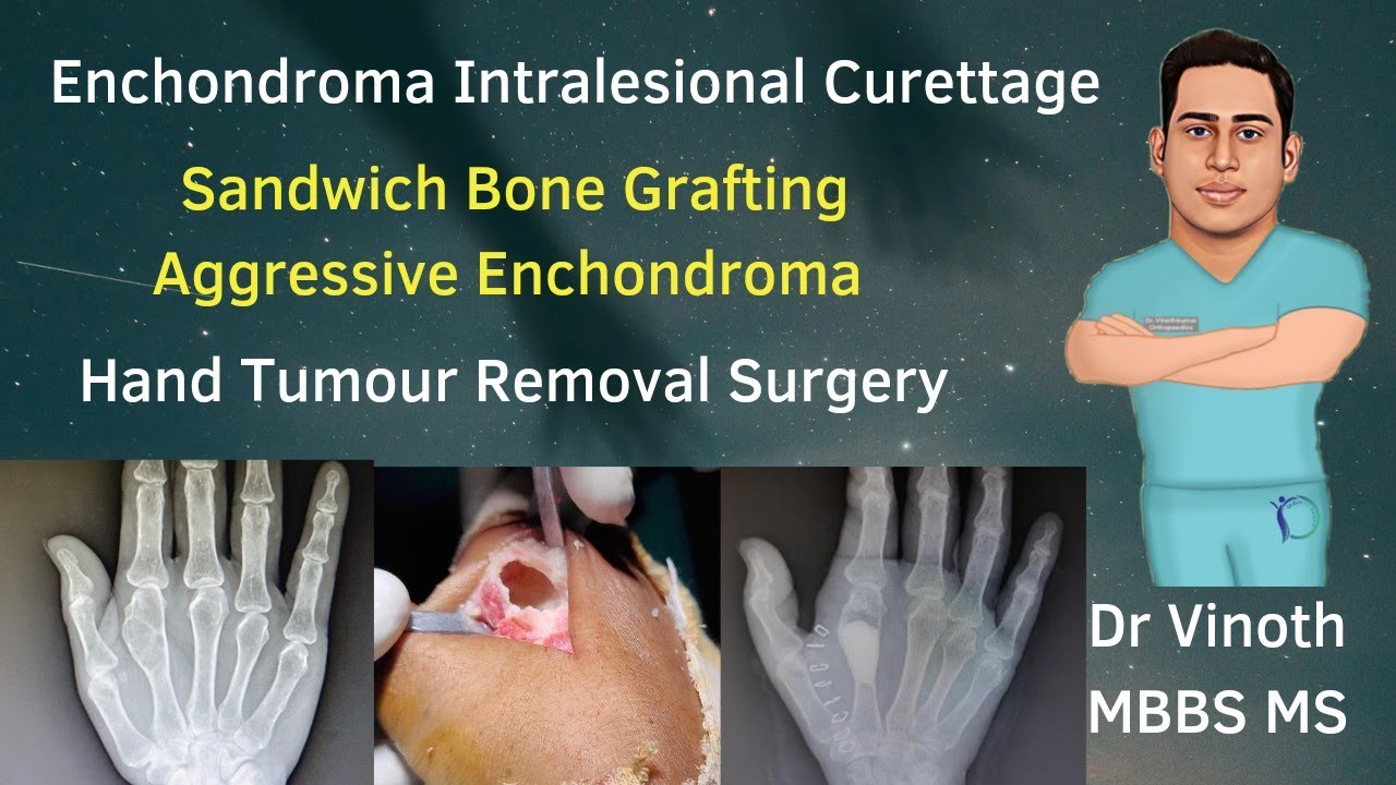 Bone Tumour removal |Enchondroma Curettage|Hand tumour surgery|Sandwich ...