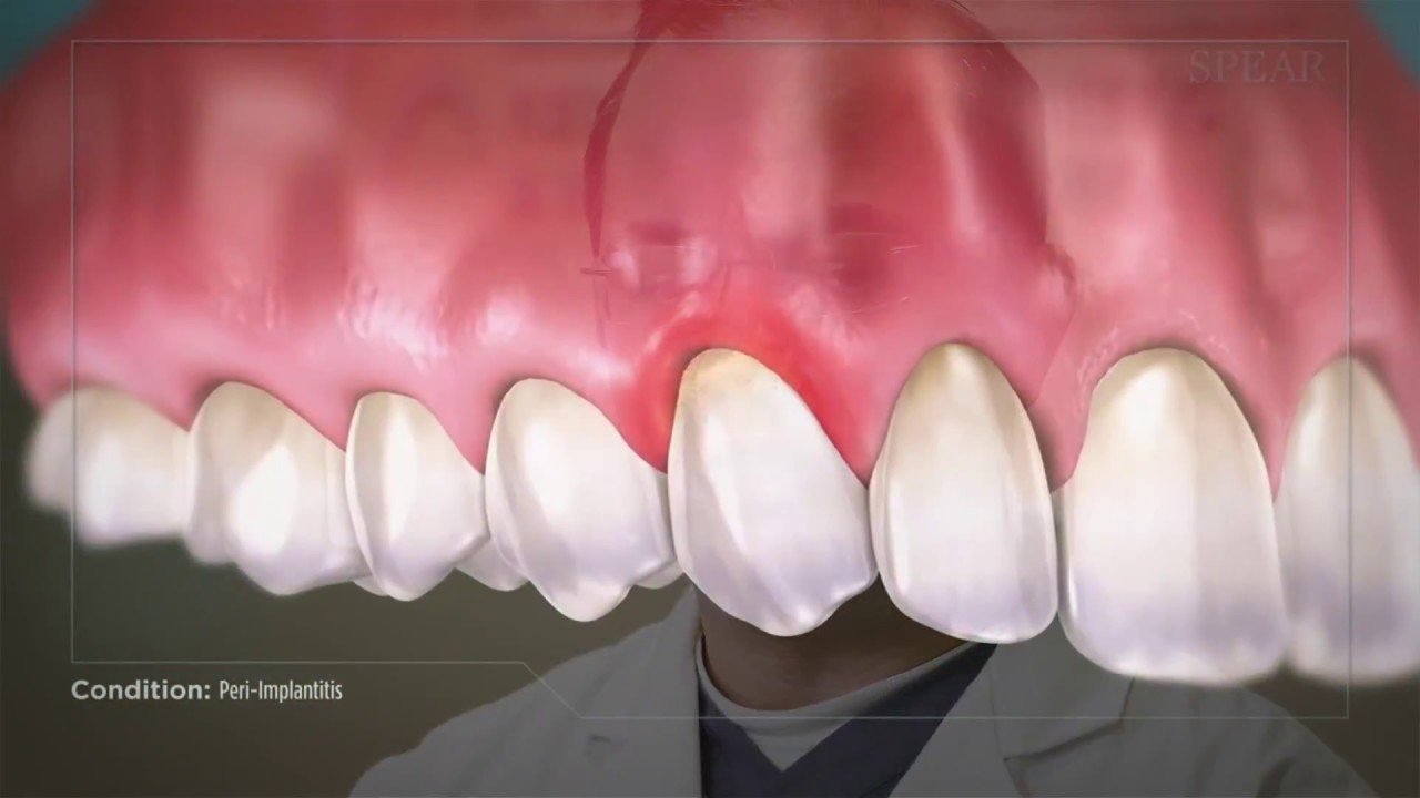 Peri Implantitis - Fort Lauderdale, FL - Dr. Burak Taskonak - Florida ...