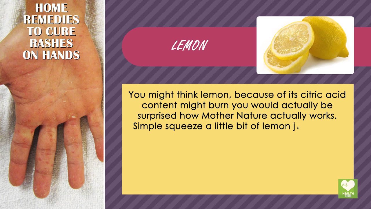 Rashes On Hands - Home Remedies | Health Tone Tips - YouTube