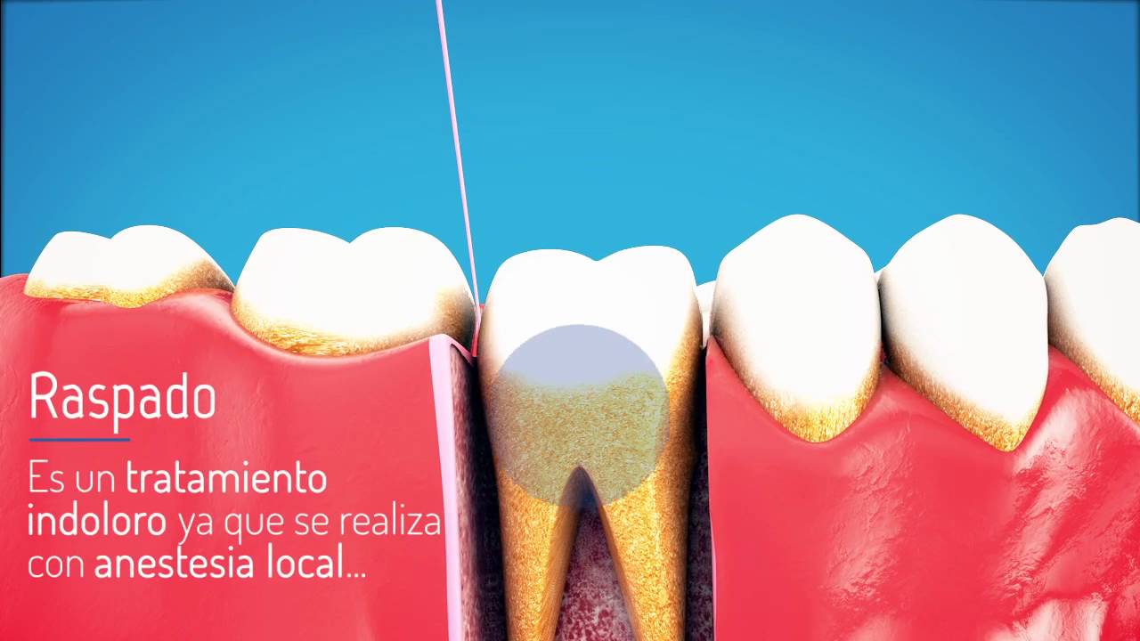 Raspado y alisado radicular - YouTube
