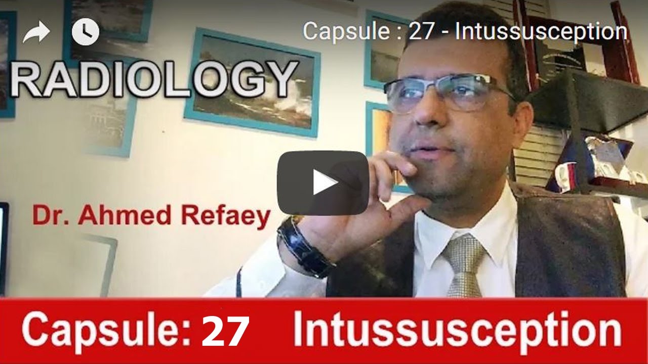 Capsule : 27 - Intussusception - YouTube