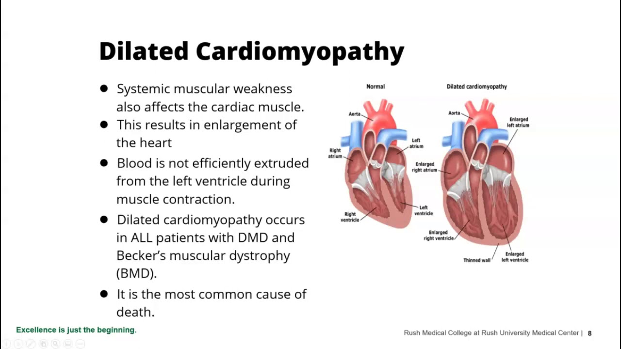 Genetics of DMD, BMD and Myotonic Dystrophy - YouTube