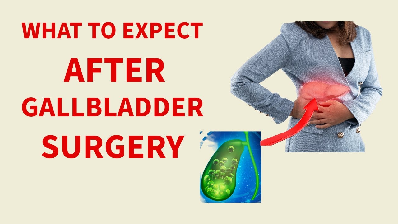 All You Need to Know About Life After Gallbladder Surgery - YouTube