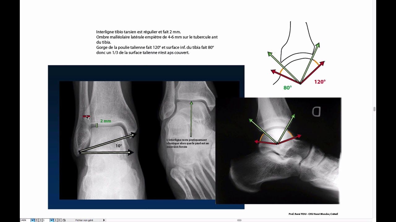 Radiologie de la cheville - YouTube