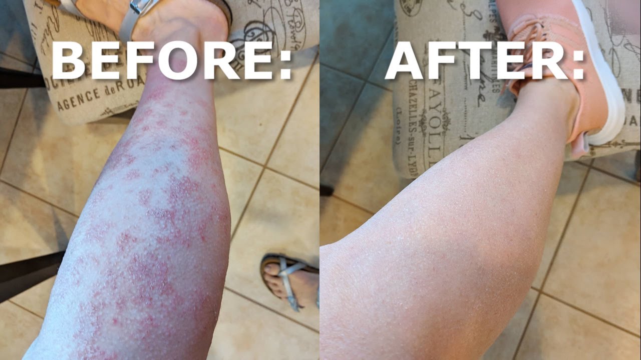 Katie shares how she healed her skin rash within weeks! - YouTube