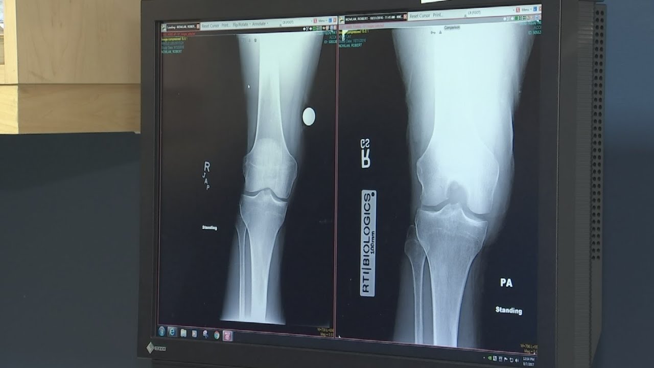 Phoenix surgeon performs Arizona's first artificial meniscus implant ...