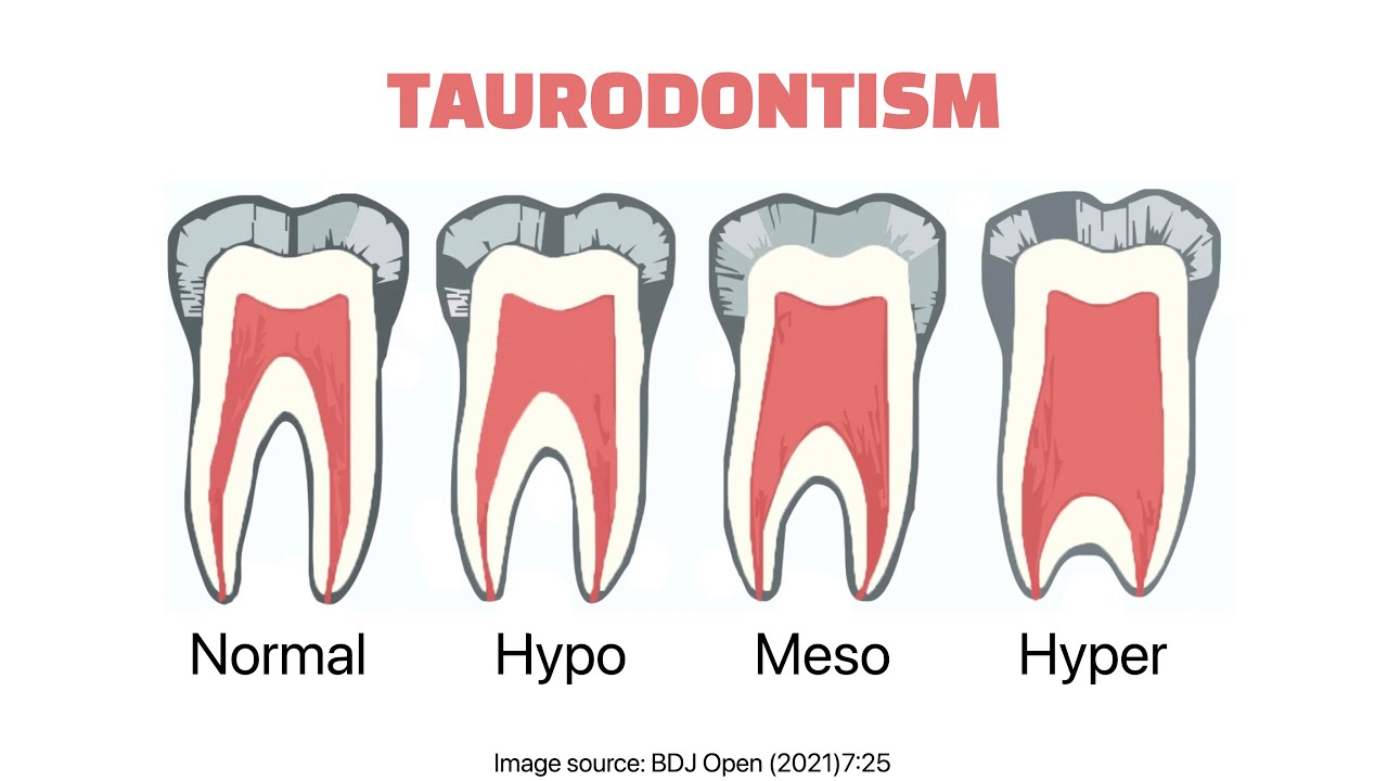 #16 Taurodontism Mx. Molar Access & Shaping - YouTube
