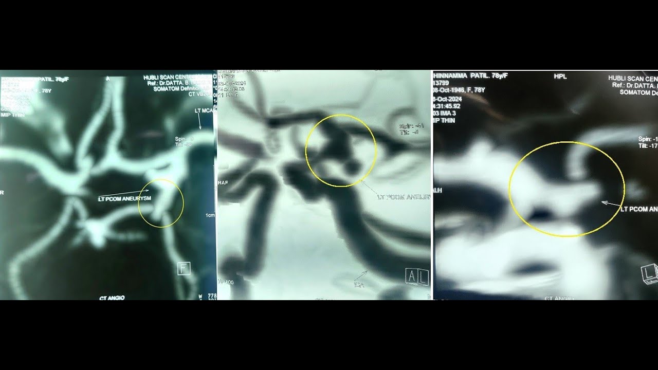 EXOSCOPIC CLIPPING-POSTERIOR COMMUNICATING ARTERY-PCOM-A- ANEURYSM- -dr ...