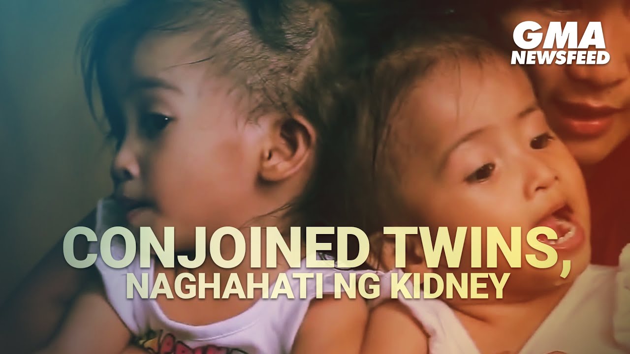 Ang laban ng conjoined twins na naghahati ng kidney | GMA News Feed ...