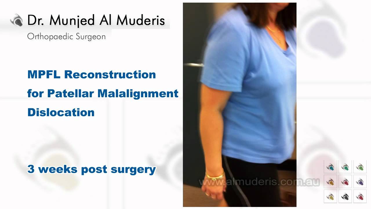 MPFL Reconstruction - 3 weeks post surgery - YouTube
