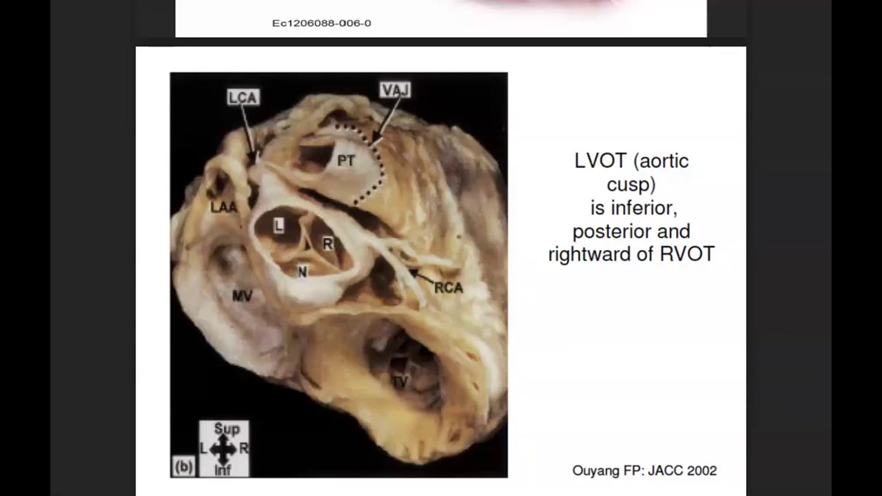 PVCs to treat or not ? - YouTube