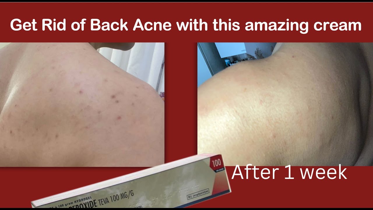 HOW I CURED MY BACK ACNE (Before/After Photos)BACK ACNE TREATMENT/درمان ...