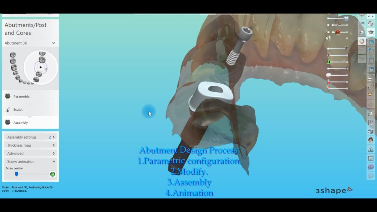 How to design a Robotic Custom Abutment with it's Positioning Key in ...